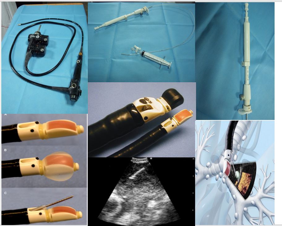 Endobronchial Ultrasound Guided Transbronchial Needle Aspiration Ebus