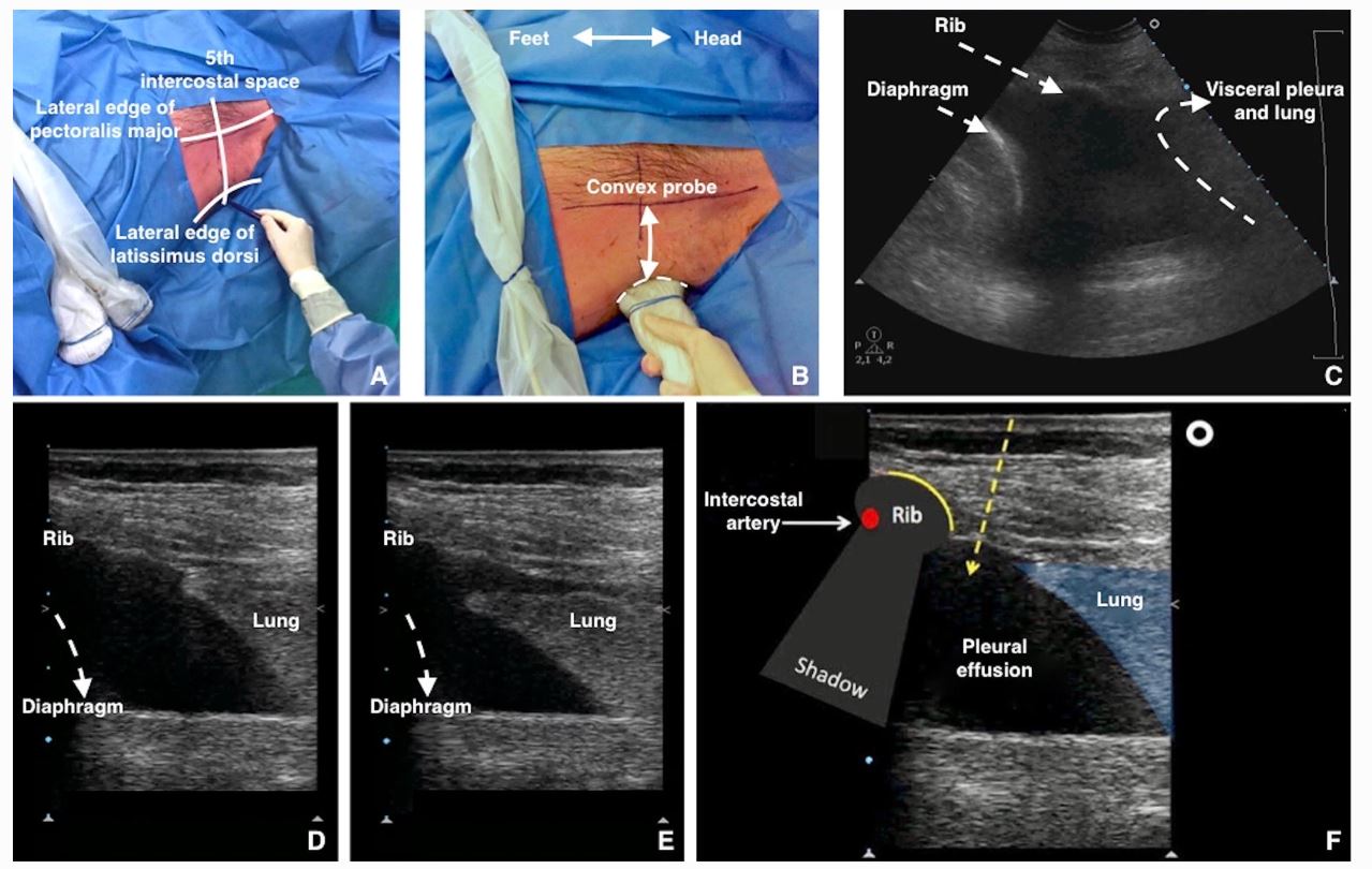 Thoracic Ultrasound – Dr. Gopal Chawla