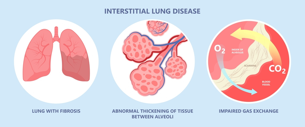 Interstitial Lung Disease – Dr. Gopal Chawla