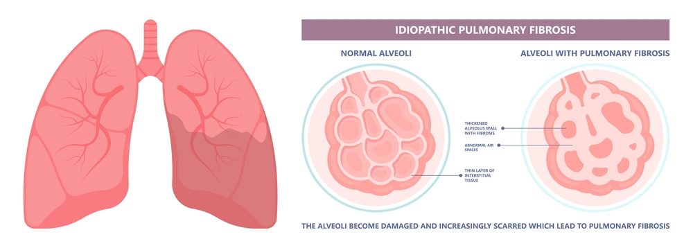 Interstitial Lung Disease – Dr. Gopal Chawla