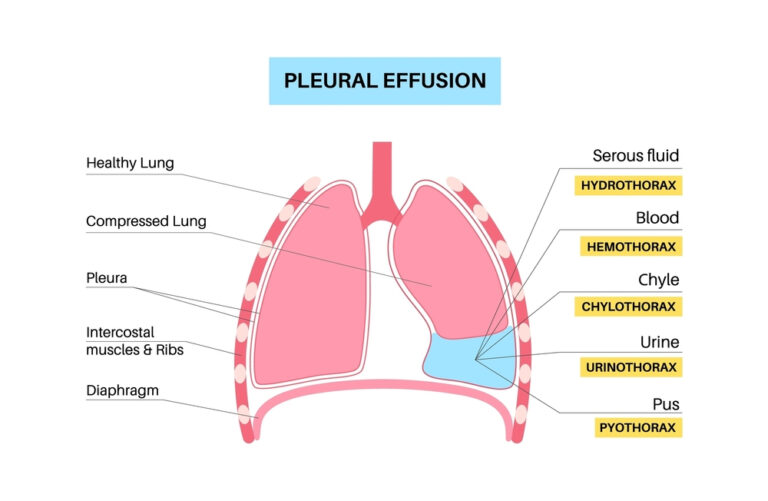 Pleural Effusion – Dr. Gopal Chawla