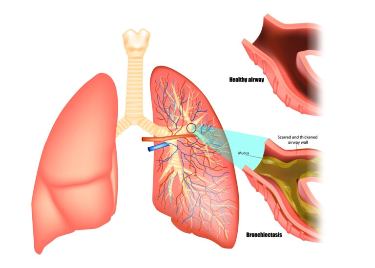Bronchiectasis – Dr. Gopal Chawla